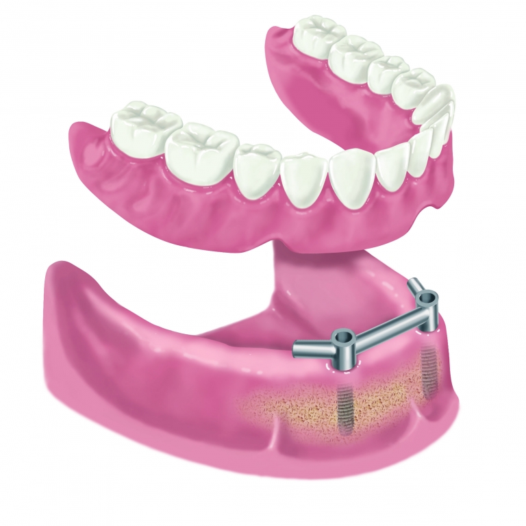 Klikgebit/prothese | Kiesz